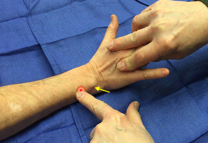 Extensor Carpi Ulnaris Ecu Tenderness Hand Surgery Resource 4041
